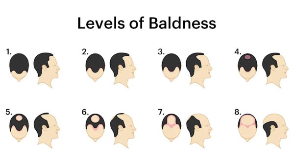 Wondering How to Solve Types of Baldness? Read This!!