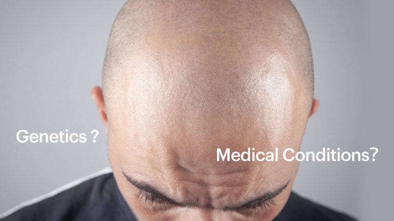 50 Best Haircuts and Hairstyles for Balding Crown in 2024