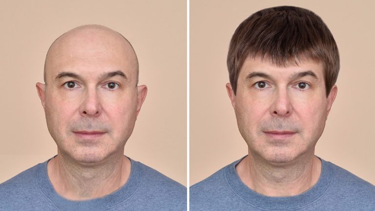 50 Best Haircuts and Hairstyles for Balding Crown in 2024