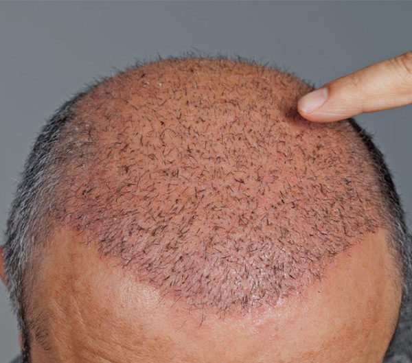 How Much Does Hair Club For Men Cost?
