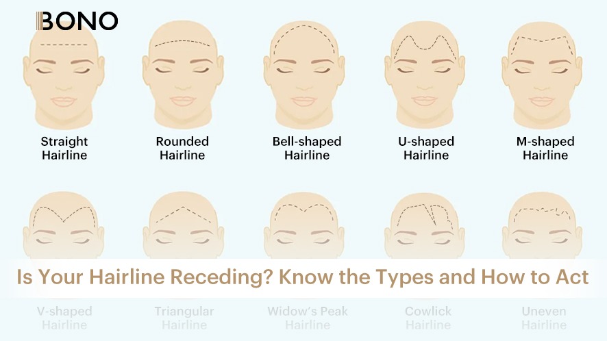 Is Your Hairline Receding? Know the Types and How to Act