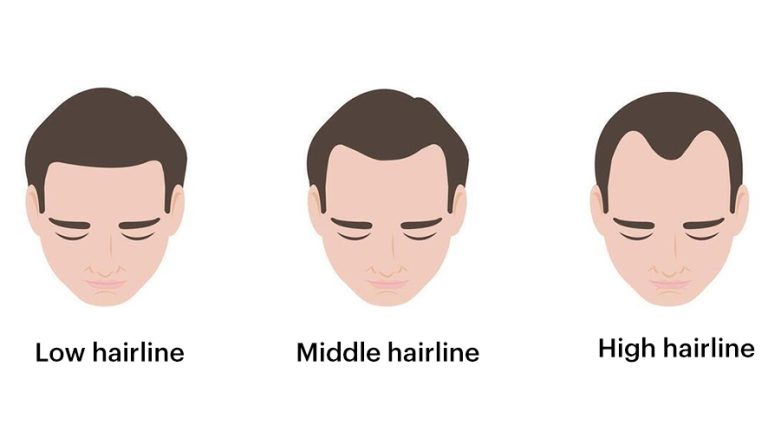 Is Your Hairline Receding? Know the Types and How to Act