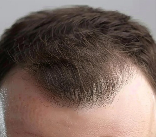 Is Your Hairline Receding? Know the Types and How to Act