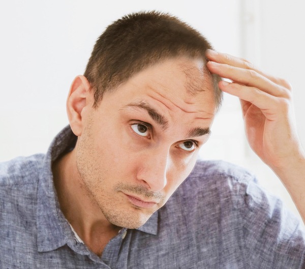 Is Your Hairline Receding? Know the Types and How to Act